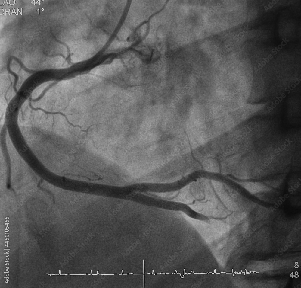 The coronary artery angiography (cag) was performed normal right ...