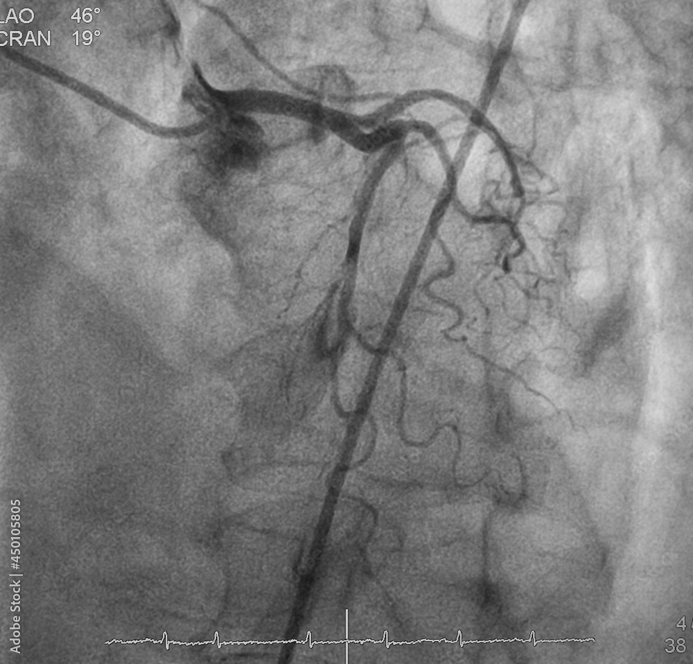 coronary angiogram (CAG) was performed normal left coronary artery (lca ...