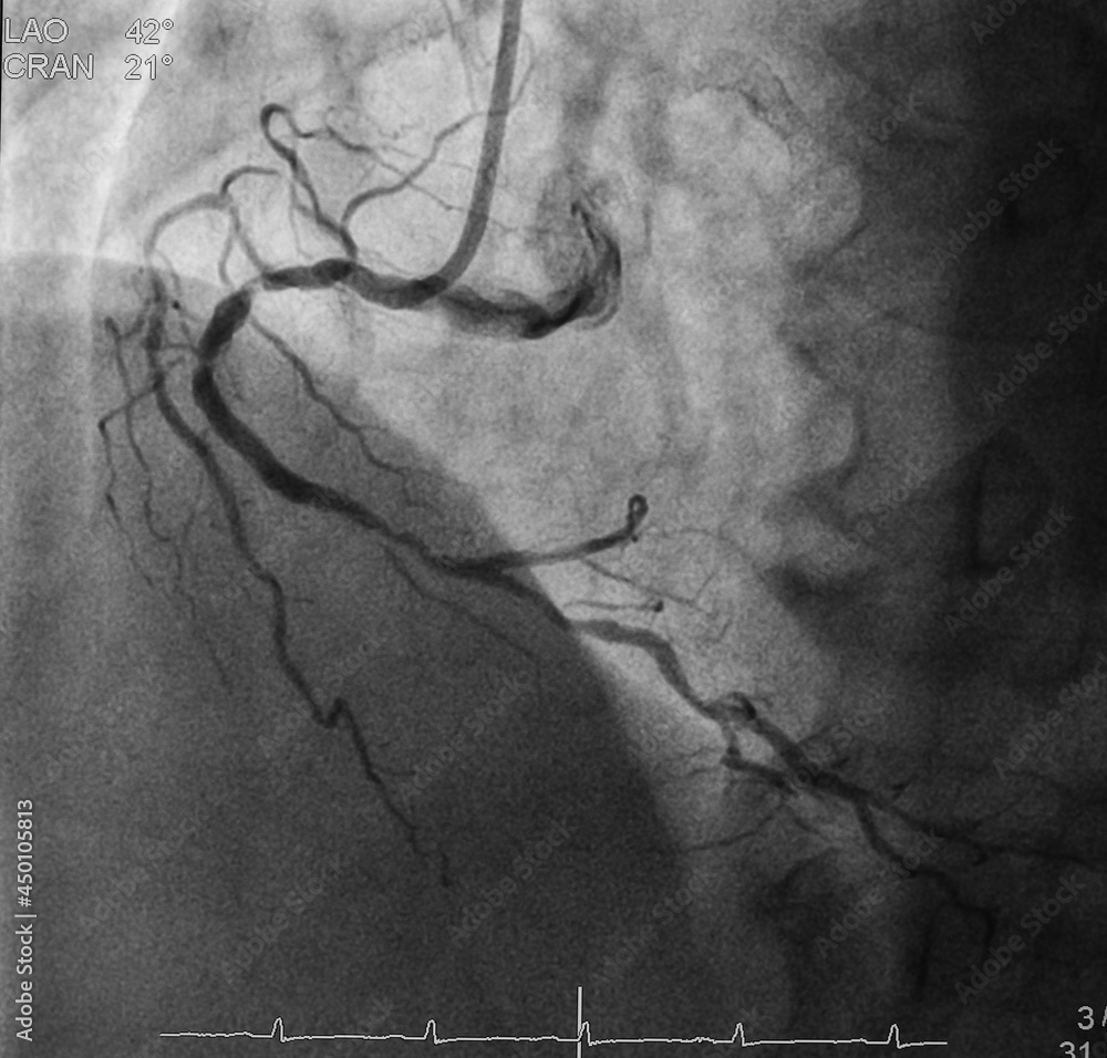 Coronary artery angiogram (CAG) of right coronary artery stenosis ...