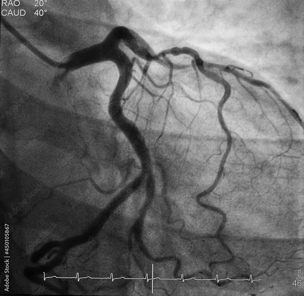 coronary angiogram (CAG) was showed left anterior descending artery ...