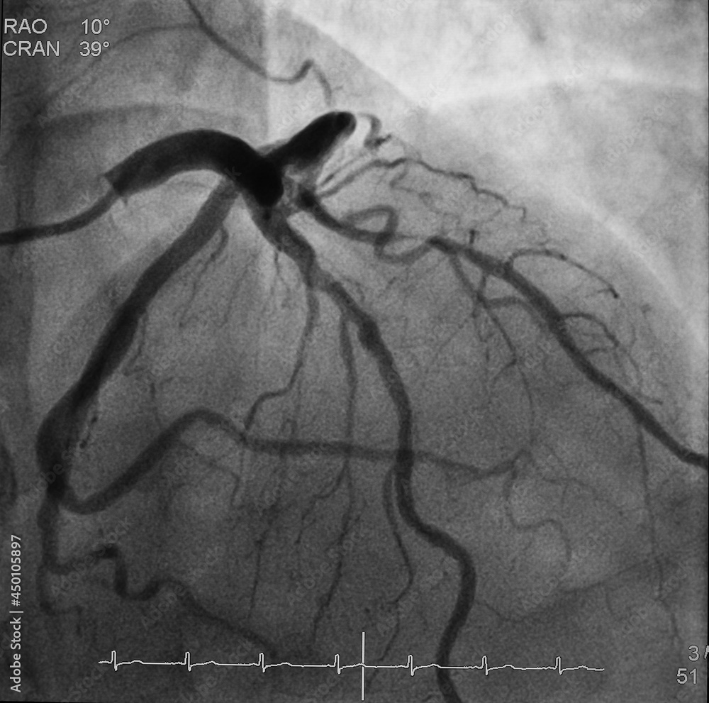 coronary angiogram (CAG) was showed left anterior descending artery ...