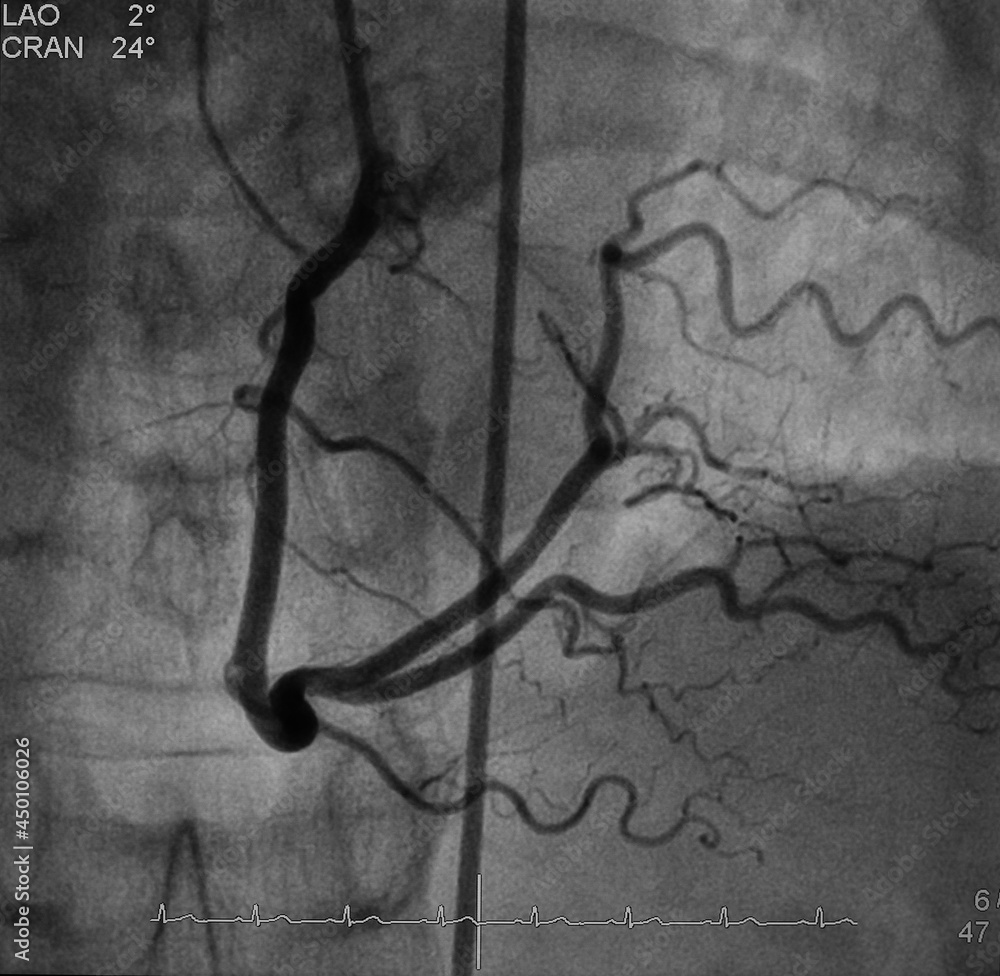 The coronary artery angiography (cag) was performed normal right ...