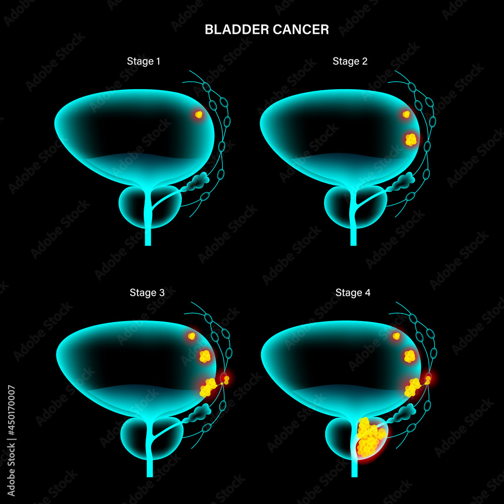 Bladder cancer stages Stock Vector | Adobe Stock