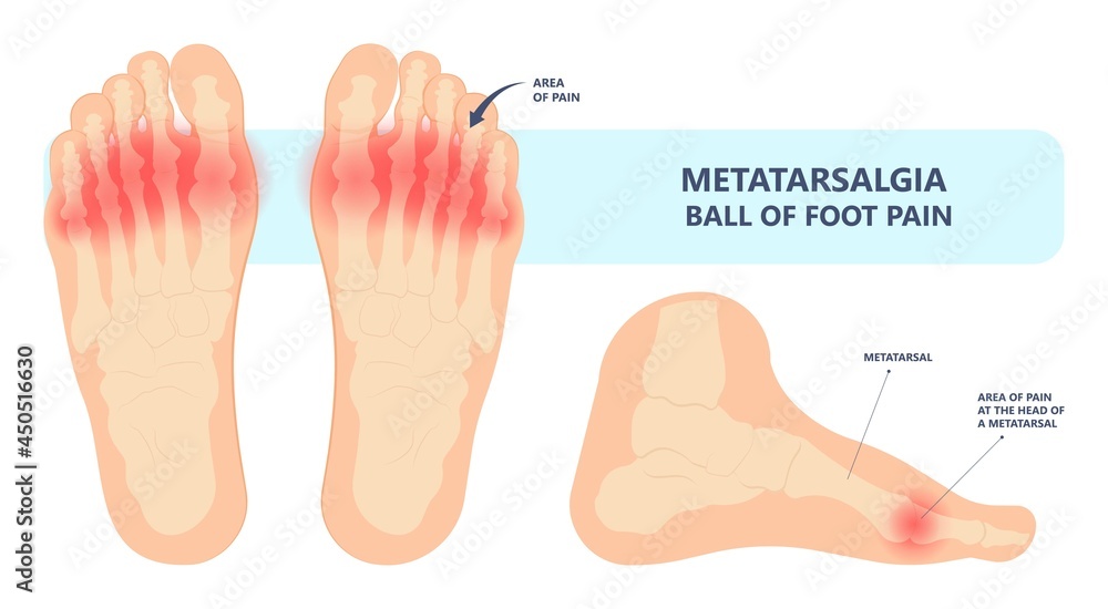 Ball foot feet sport injury shoes toe ache runner high big heels hammer ...