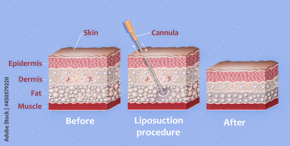 Mechanism of liposuction. Suction-assisted liposuction. Hollow tube or ...