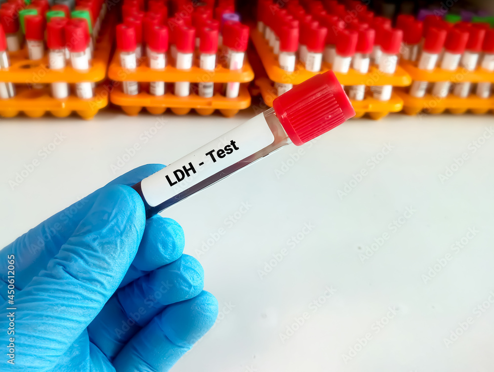 Blood sample for Iron test. Anemia. Iron deficiency anemia Stock Photo ...