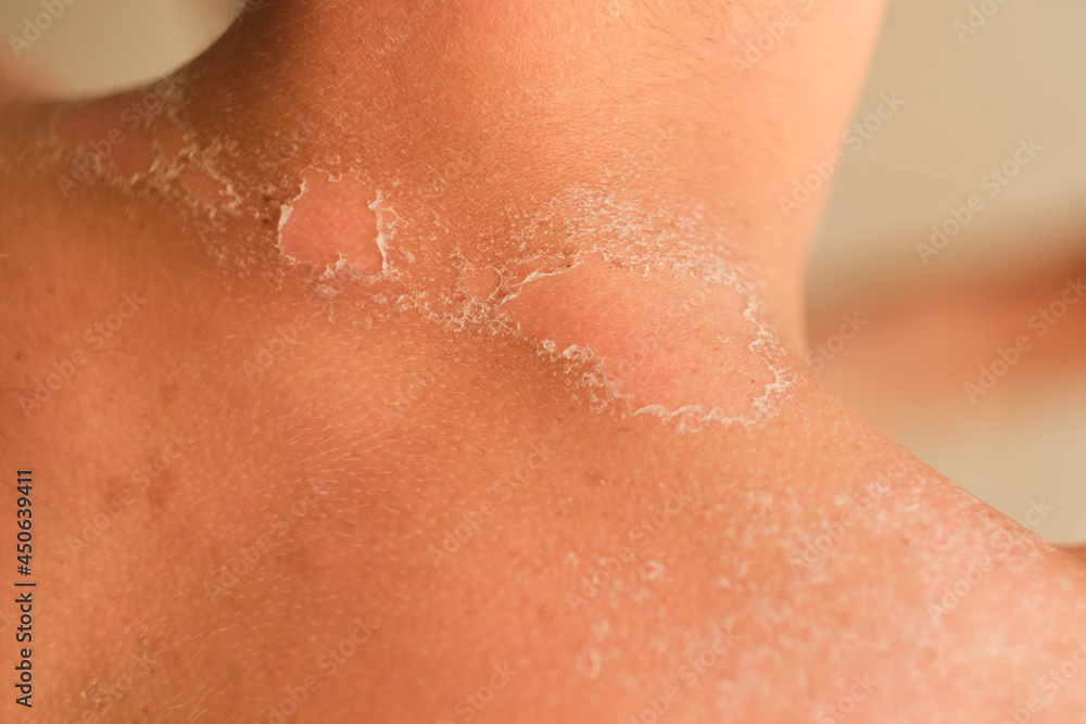 unrecognizable guy got sunburn and got tan lines on his back. The skin ...