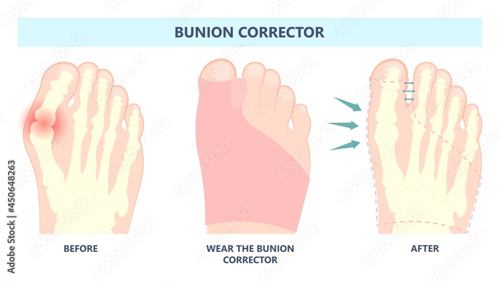 bony bump joint big toe bone enlarge fifth foot pain shoe Tailor ...