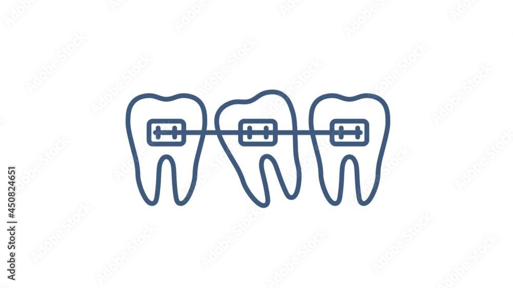 Correction of teeth with orthodontic braces. Stages of teeth alignment ...