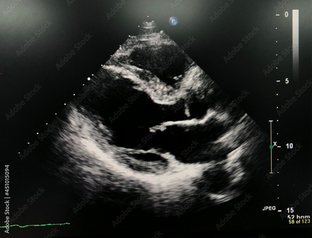 Foto de Transthoracic echocardiogram (TTE) of parasternal long axis view. do Stock | Adobe Stock