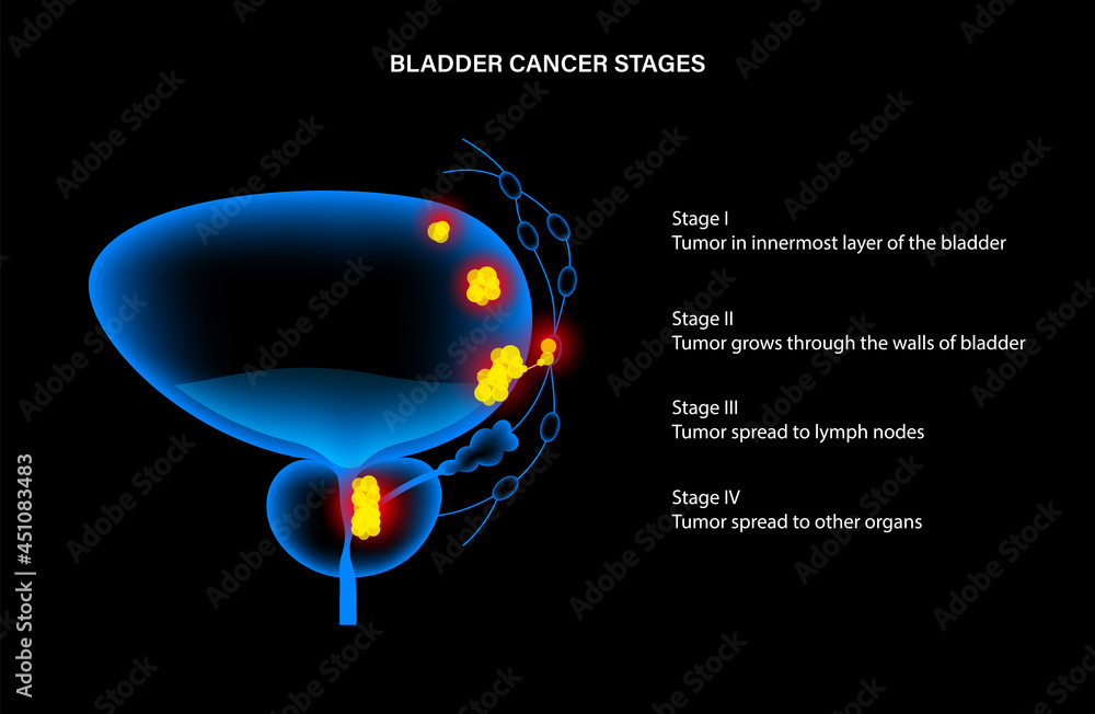 Bladder cancer stages Stock Vector | Adobe Stock