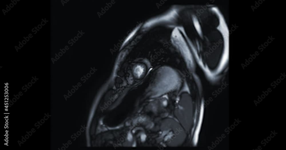 MRI heart or Cardiac MRI ( magnetic resonance imaging ) of heart in ...