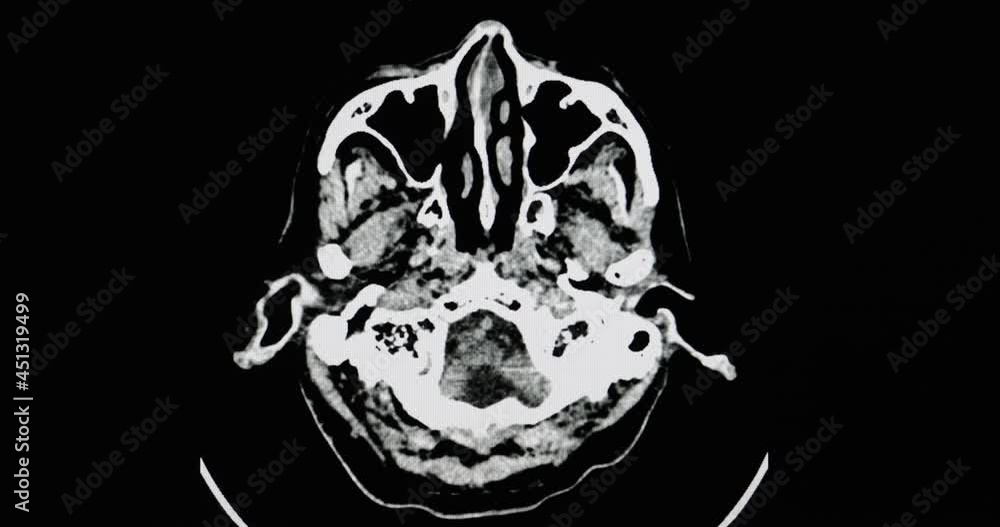 CT brain scan of a brain of a patient with acute lacuna infarction in ...