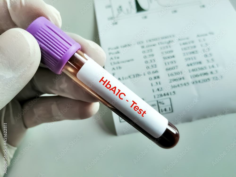 Blood sample for HbA1c (Hemoglobin A1c) test. Diabetic treatment ...