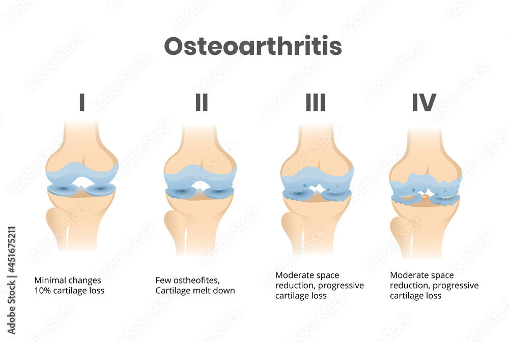 Photo & Art Print Osteoarthritis four stages anatomical and scientific ...