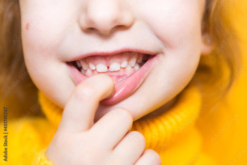 Girl shows her teeth-pathological bite, malocclusion, overbite ...