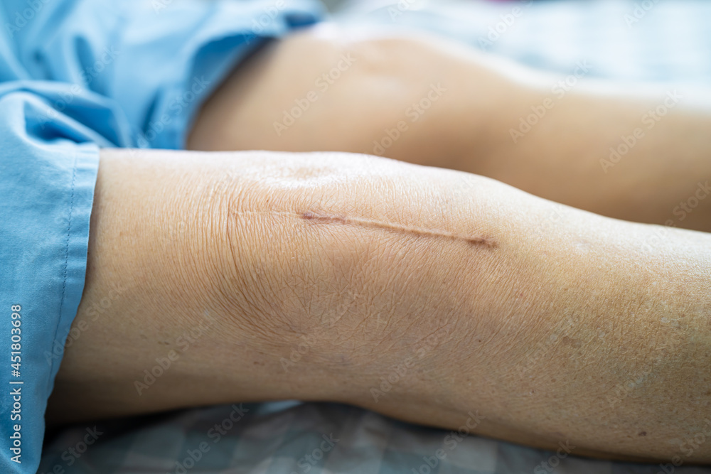 Asian senior or elderly old lady woman patient show her scars surgical ...