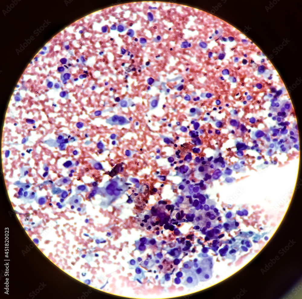 Metastatic Squamous cell carcinoma of a human, photomicrograph as seen ...