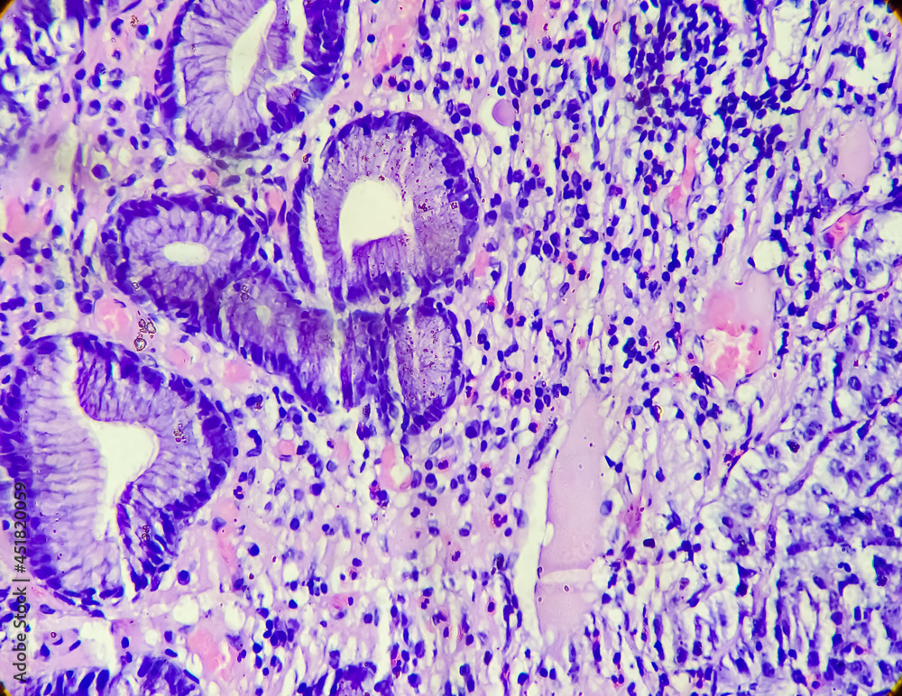 Photomicrograph of a carcinoid tumor, a type of neuroendocrine tumor ...