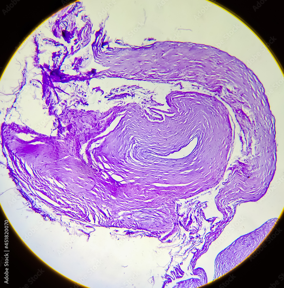 Sections show cyst wall composed of fibrocollagenous tissue human ankle ...