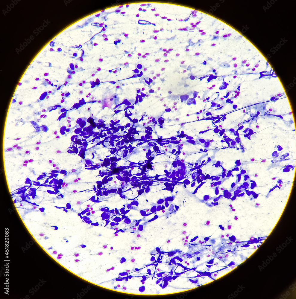 Metastatic Squamous cell carcinoma of a human, photomicrograph as seen ...