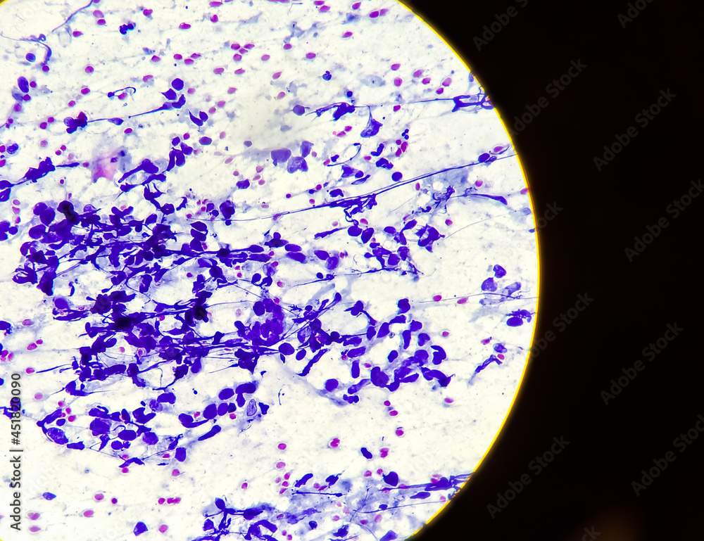 Metastatic Squamous cell carcinoma of a human, photomicrograph as seen ...