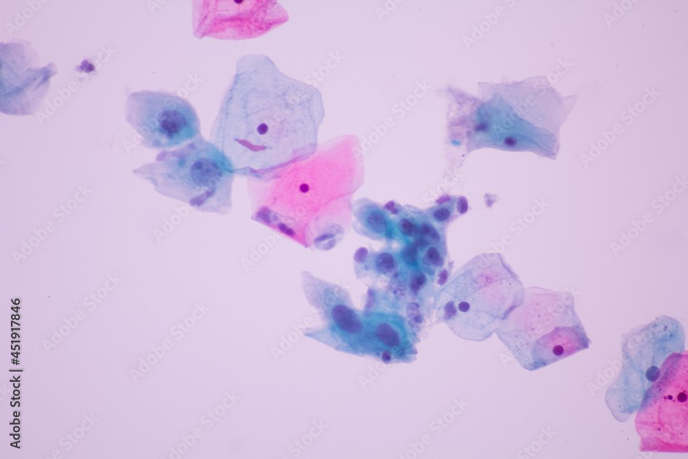 View in microscopic of Abnormal human cervix cells.Squamous epithelium ...