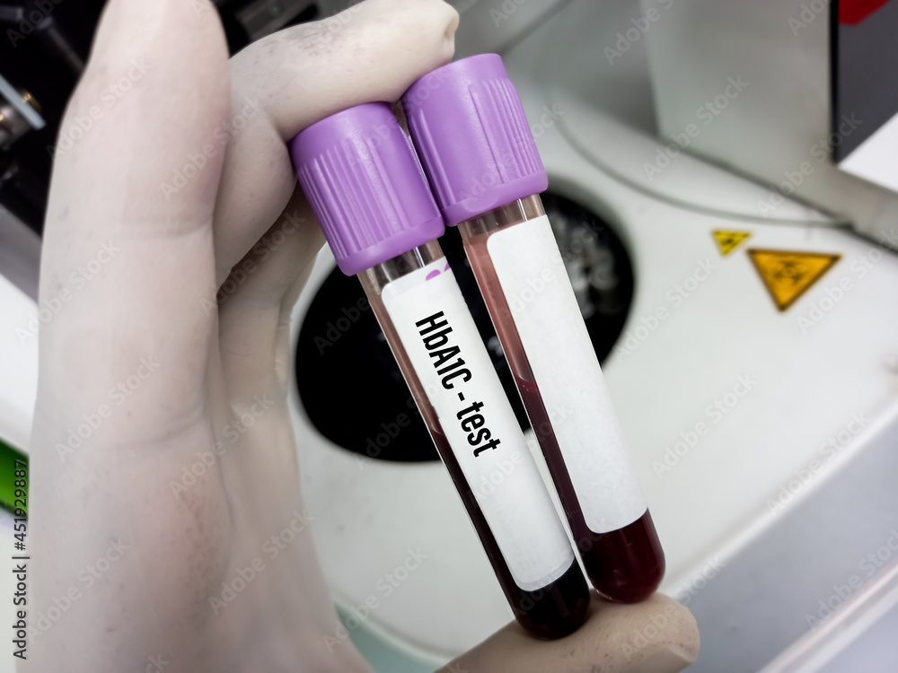 Blood sample for HbA1c test, diabetes diagnosis Stock Photo | Adobe Stock
