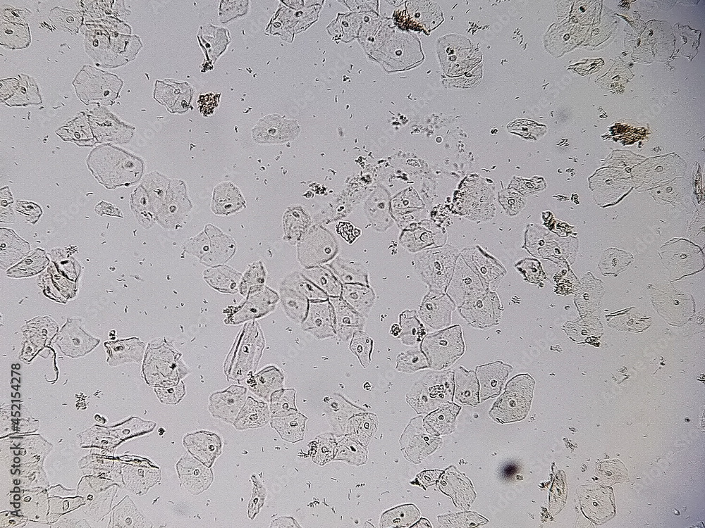 Epithelial cells with bacteria in patient urine (urinary tract ...