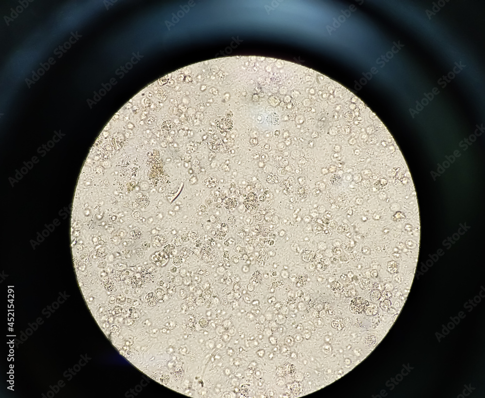 Urine sediment microscopic show plenty of pus cells or white blood cell ...