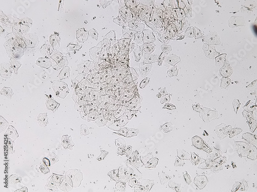 Epithelial cells with bacteria in patient urine (urinary tract ...