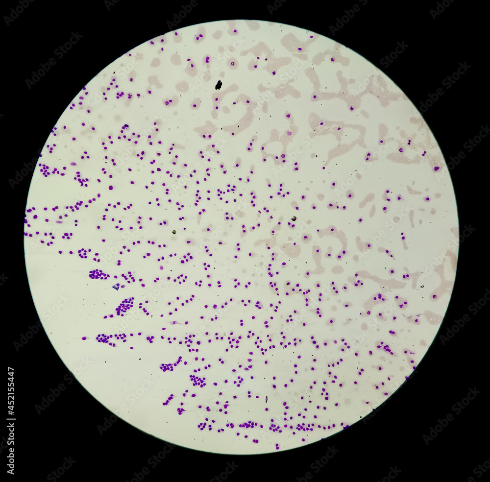 Blood smear under microscopy showing on Adult acute myeloid leukemia ...