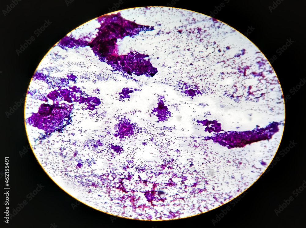 Liver SOL (CT guided FNA) microscopic 100x show positive for malignant ...