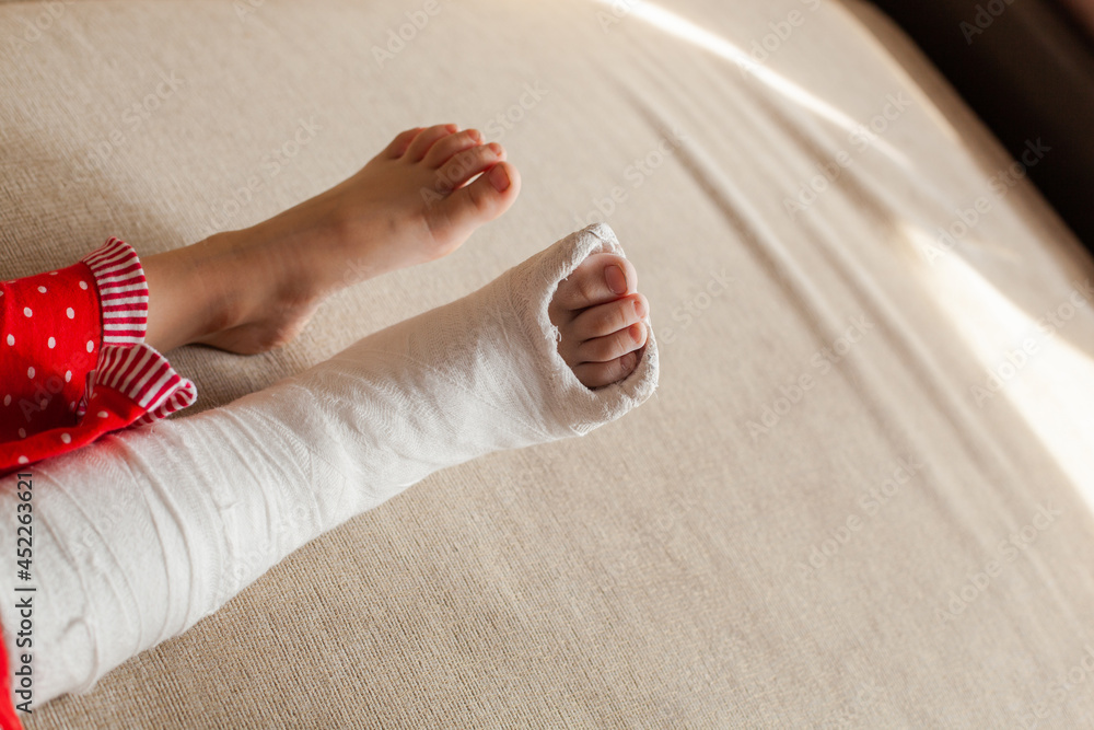 injured leg of an unrecognizable girl in a cast lying on the sofa at ...