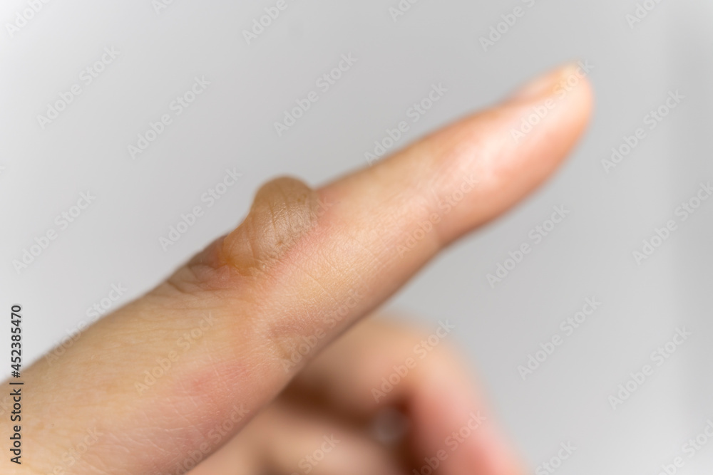There is a blister on woman's hand from a burn. Burn of the finger. A ...