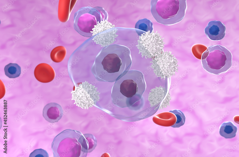 Reed-Sternberg cell in hodgkin lymphoma attacked by t-cells isometric ...