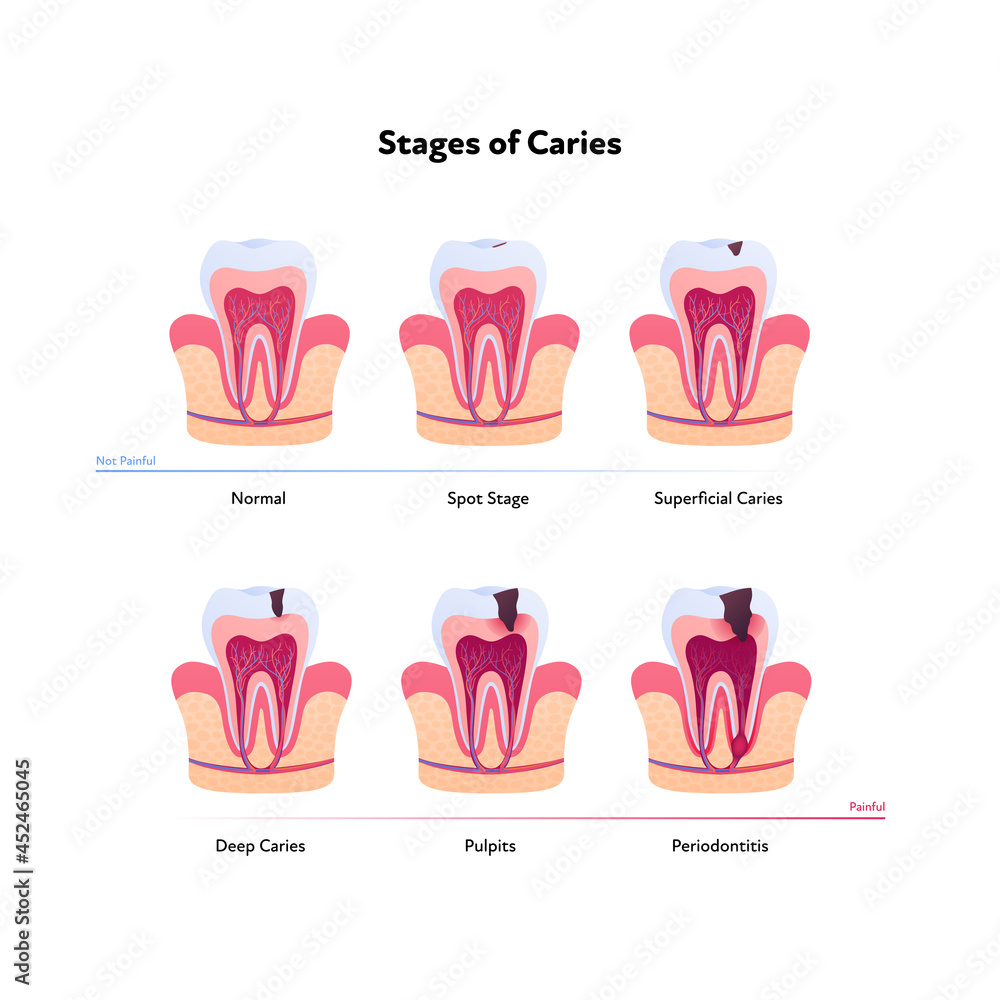 Tooth anatomy and decay chart. Vector biomedical illustration. Cross ...