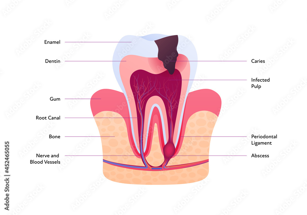 Tooth anatomy and decay chart. Vector biomedical illustration. Cross ...