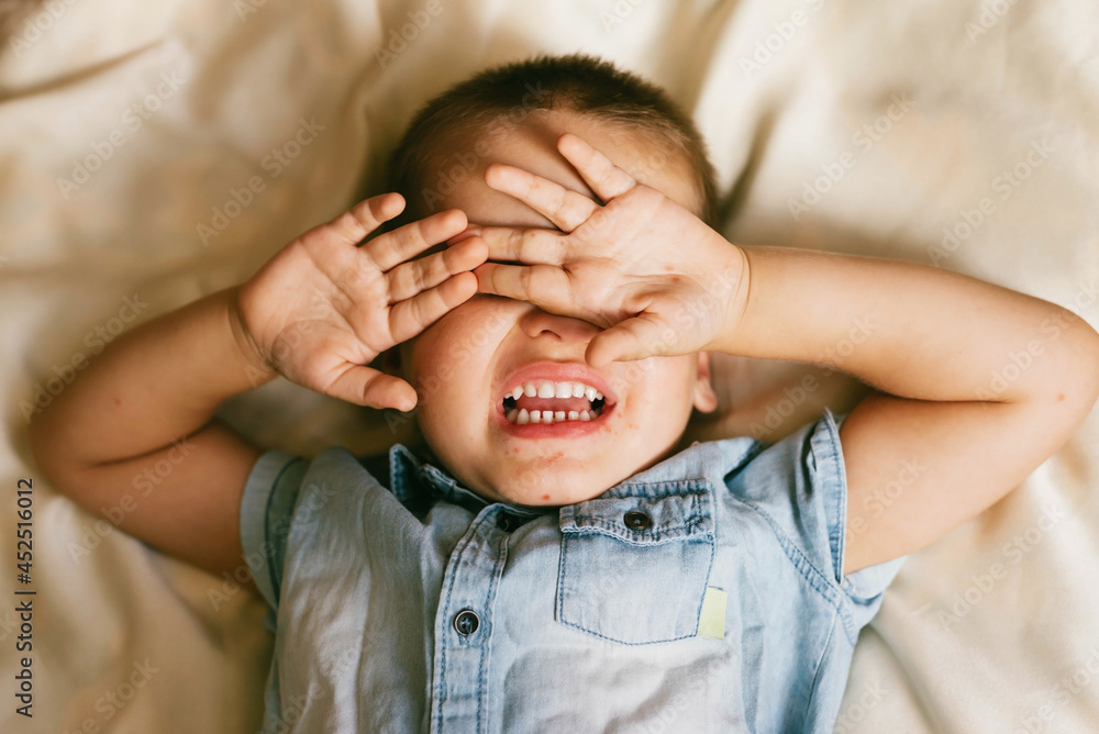 Rash of enterovirus infection picornavirus families on the face of a 3 ...