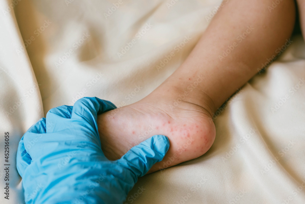 Rash of enterovirus infection picornavirus families on the feet of a 3 ...