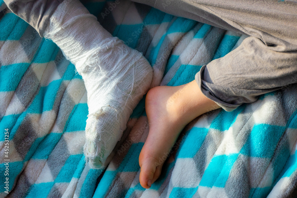 Child with bandage on leg heel fracture. Broken right foot, splint of ...