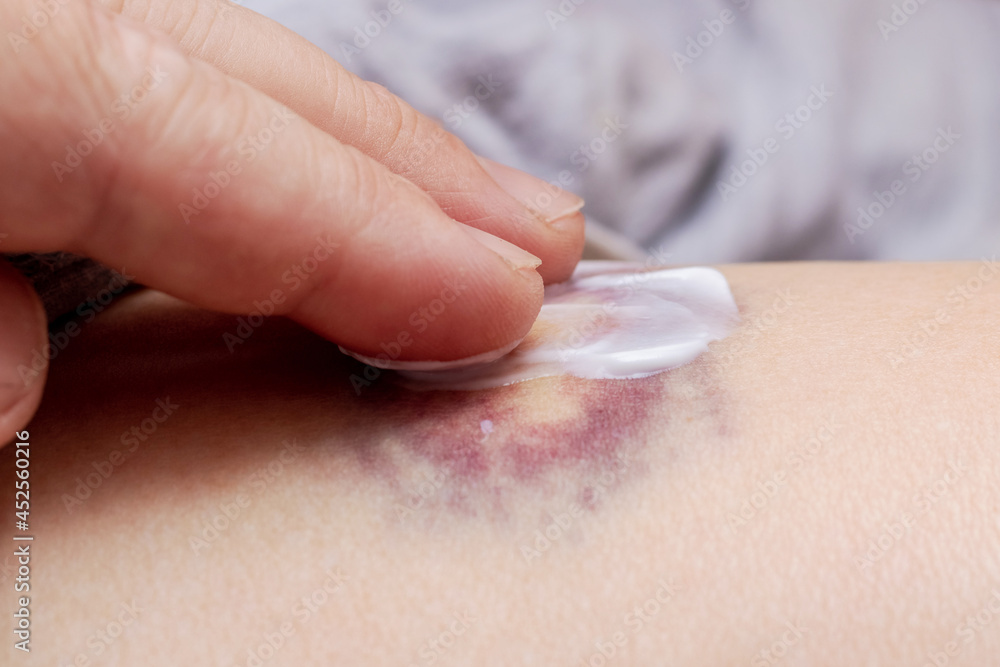 Applying ointment on the hematoma. Hematoma treatment Stock Photo ...
