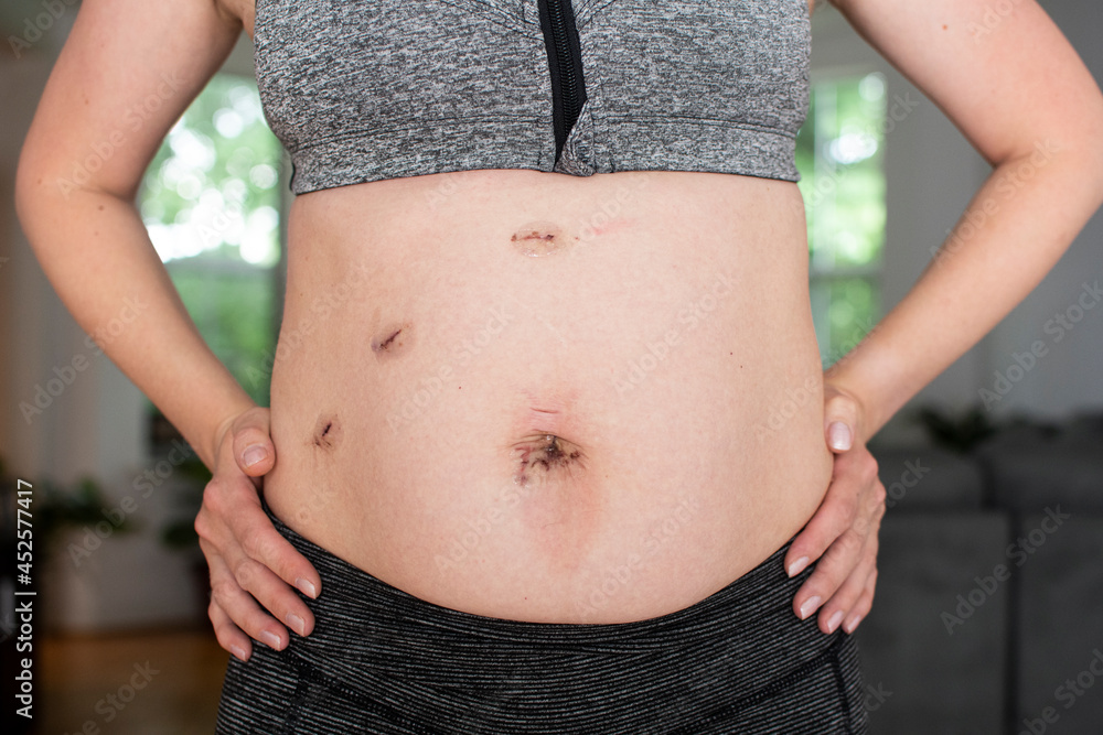 Laparoscopic cholecystectomy surgery scars. Gallbladder removal surgery ...