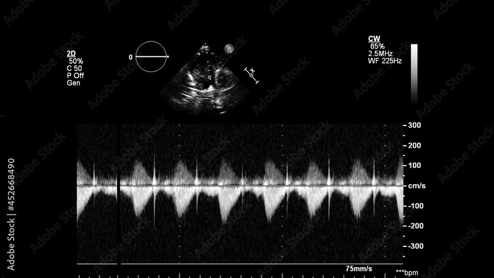 Image of the heart in gray-scale mode during transesophageal ultrasound ...