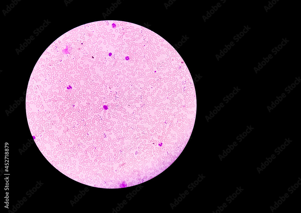 Microscopic image of Hereditary hemolytic anemia with copy space ...