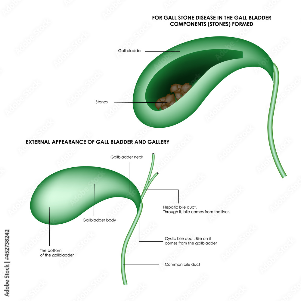 The structure of the gallbladder and stones in the gallbladder ...