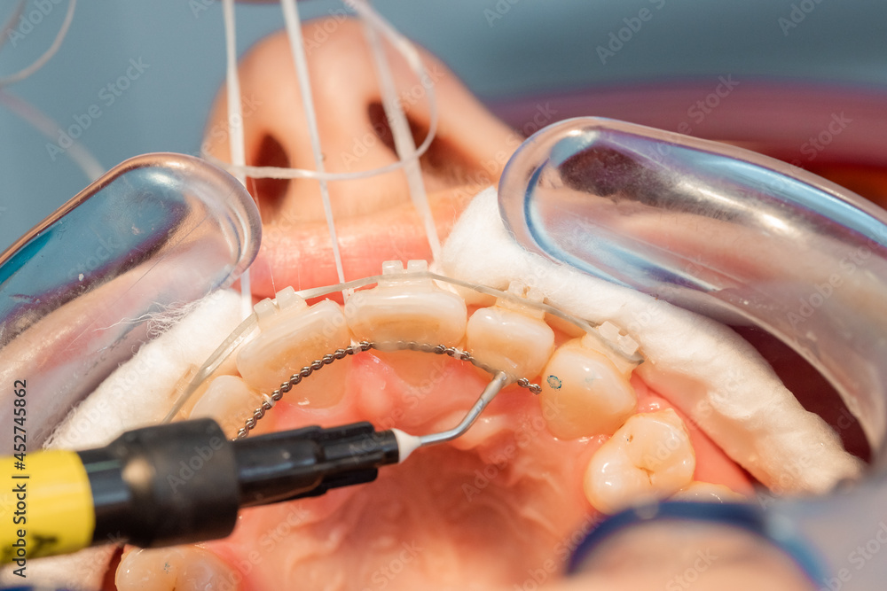 Foto de placing the fixed retainer in Process of removing dental braces ...