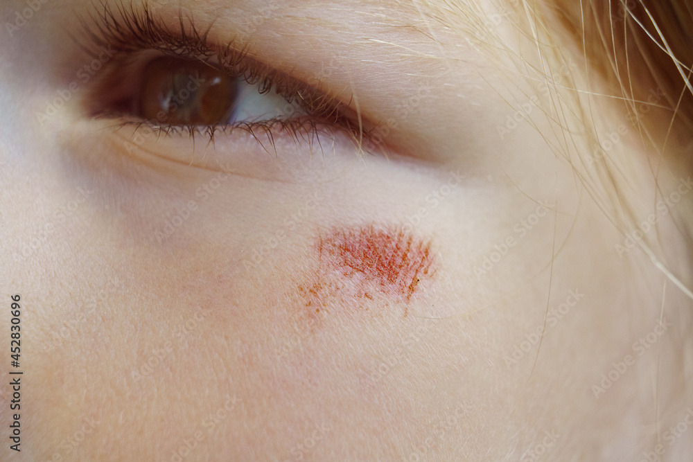 Portrait girl with an abrasion under her eye. child abuse. wounds and ...