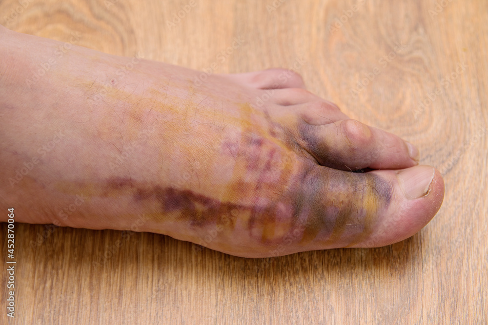 Swollen injured male limb on the left foot with hematoma when a heavy ...