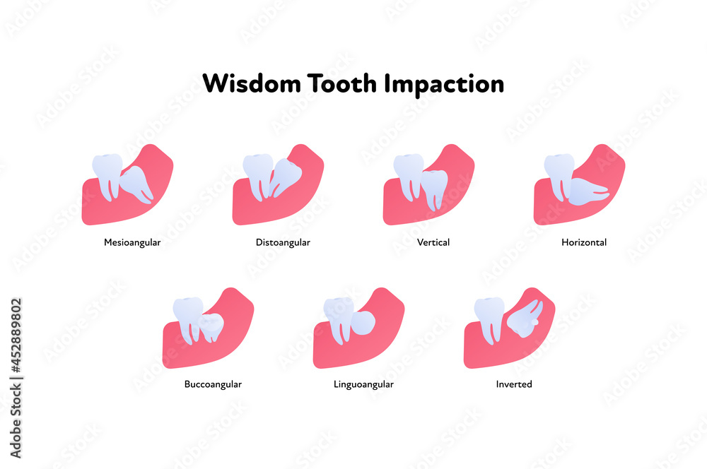 Tooth anatomy chart. Vector biomedical illustration. Cross section ...